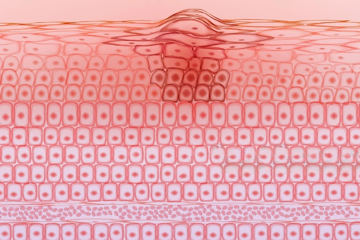 Polarized vs Non-Polarized Dermoscopy: Clinical Guide | IBOOLO
