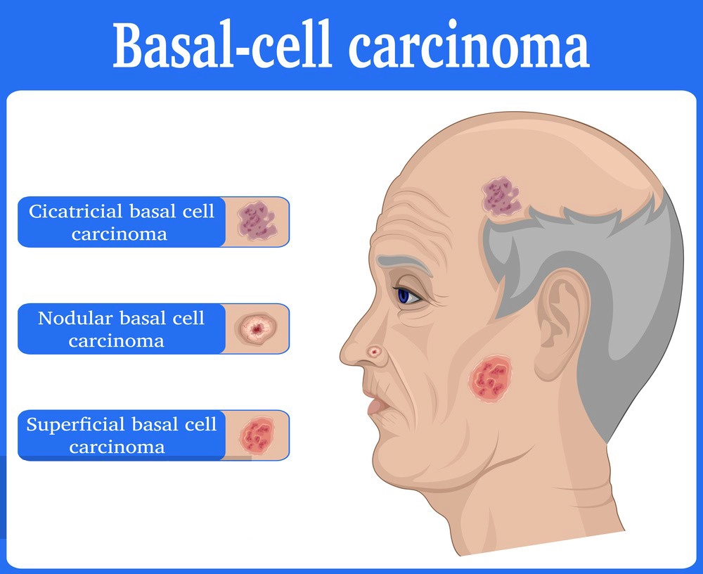 Pigmented Superficial Basal Cell Carcinoma Dermoscopy: 7 Key Warning ...