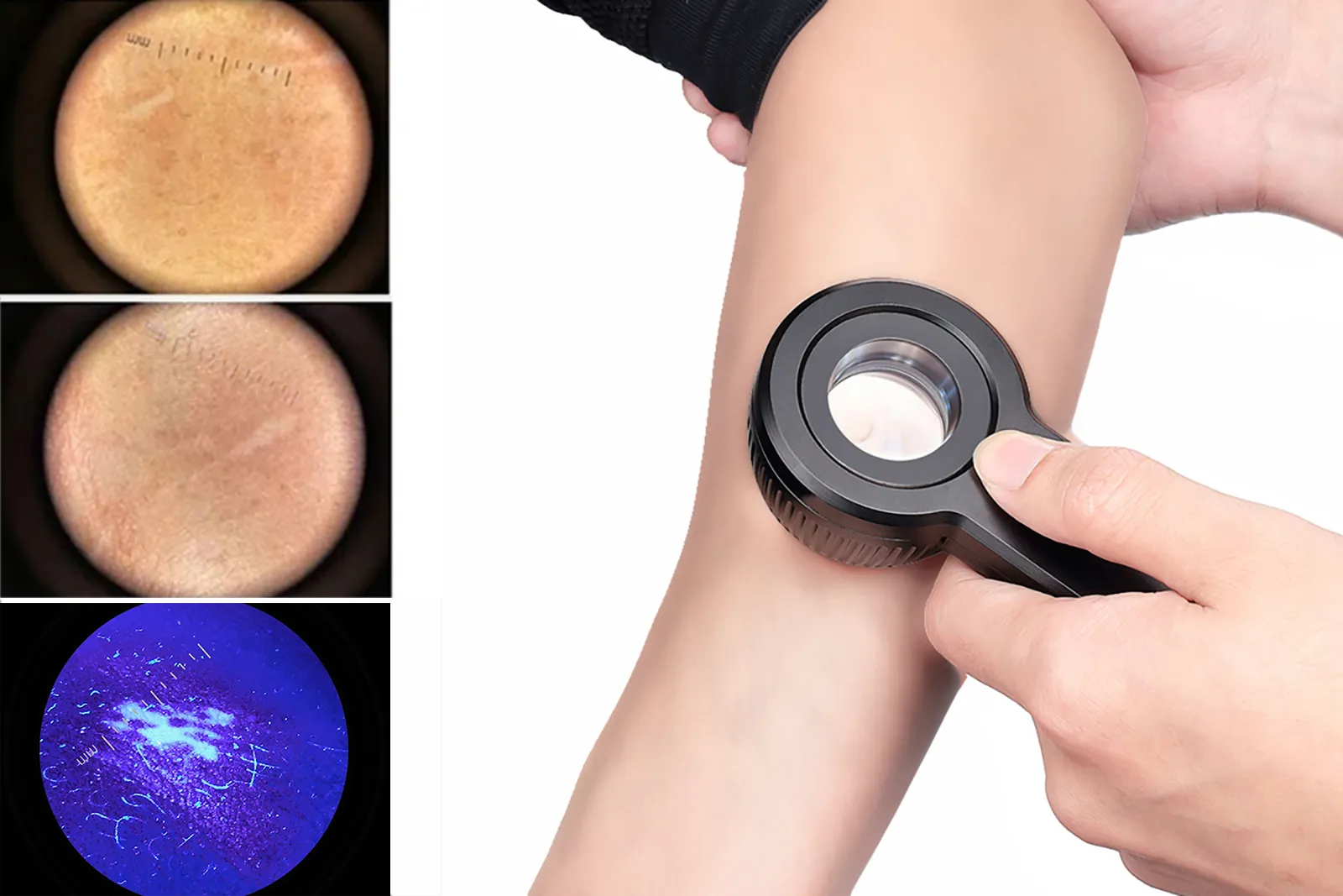 Dermoscopy of Squamous Cell Carcinoma Unveiled - IBOOLO