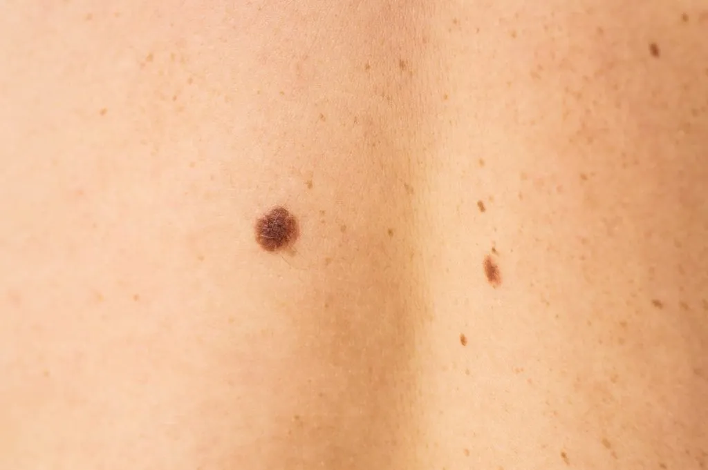 Dermoscopy of Seborrheic Keratosis: Identification & Diagnosis - IBOOLO