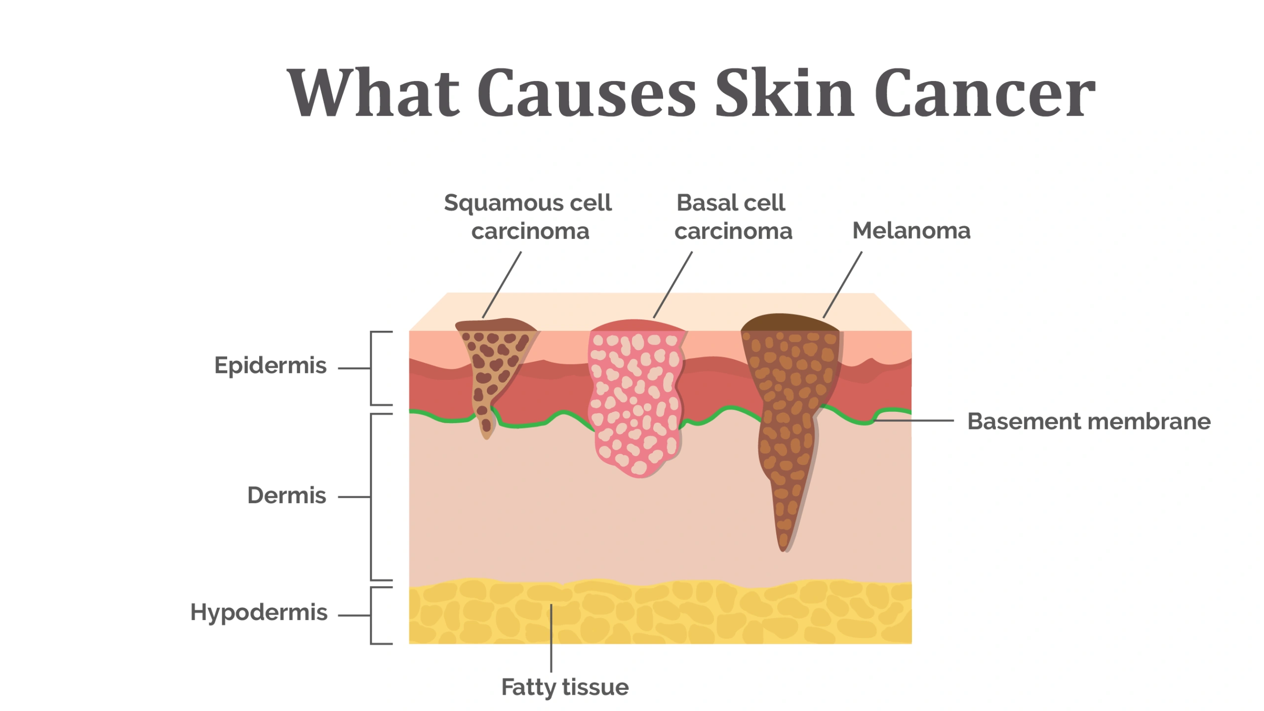 What Causes Skin Cancer? – IBOOLO